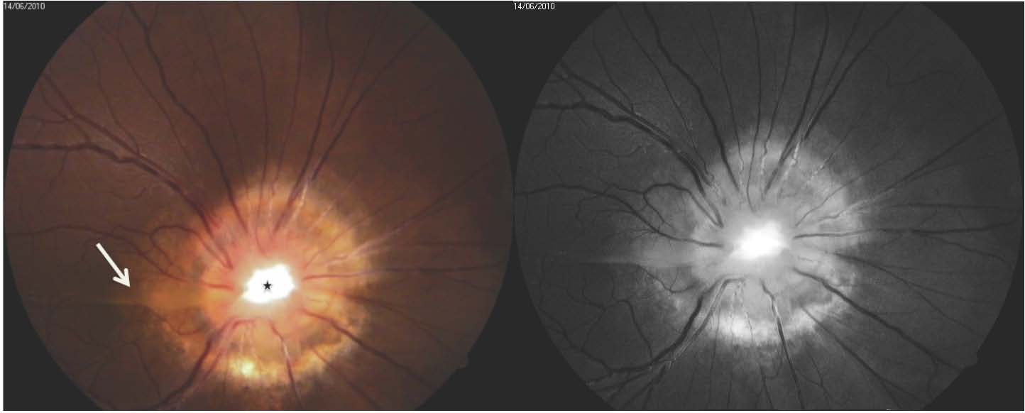 Morning Glory Optic Disc