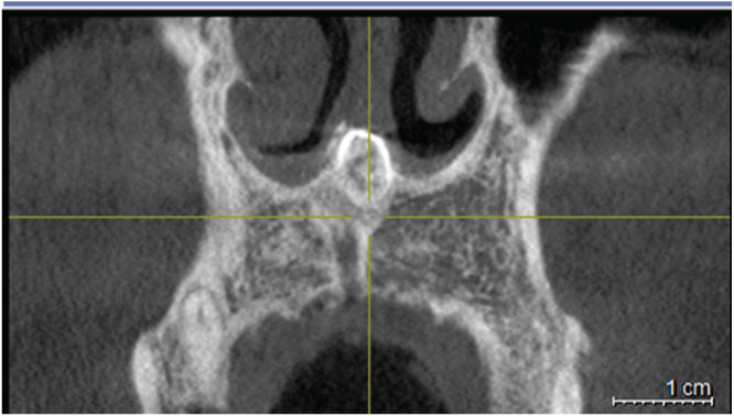Supernumerary Teeth In Nose
