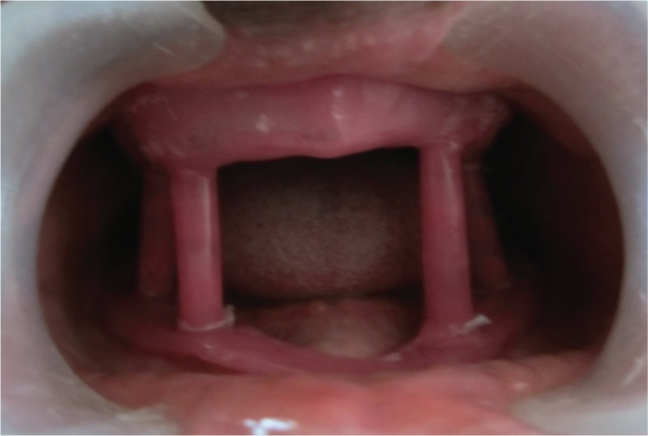 Neutral zone recording