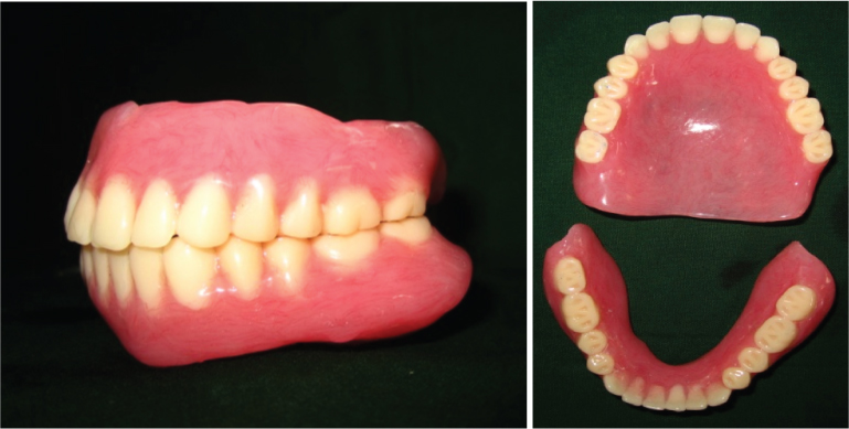 Denture inserted
