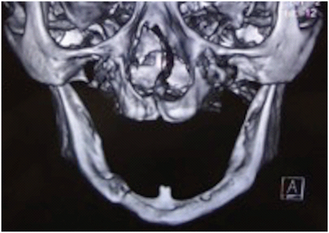 Genial Tubercle Radiograph
