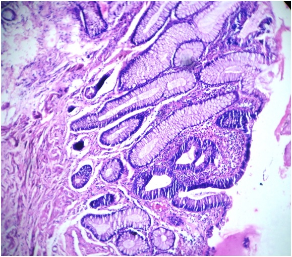 Photomicrograph showing Adenomatous polyp with dysplasia (10x X 40x)