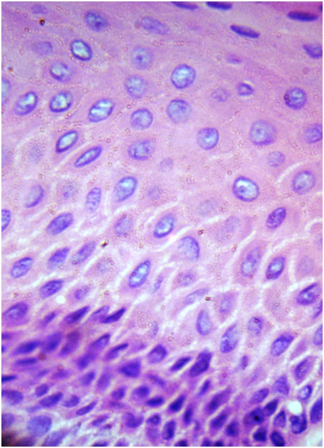 Oral Leukoplakia under 40X magnification