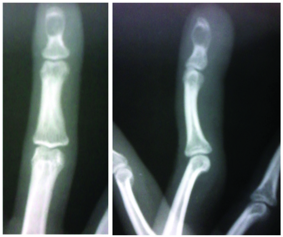 Epidermal Inclusion Cyst Finger