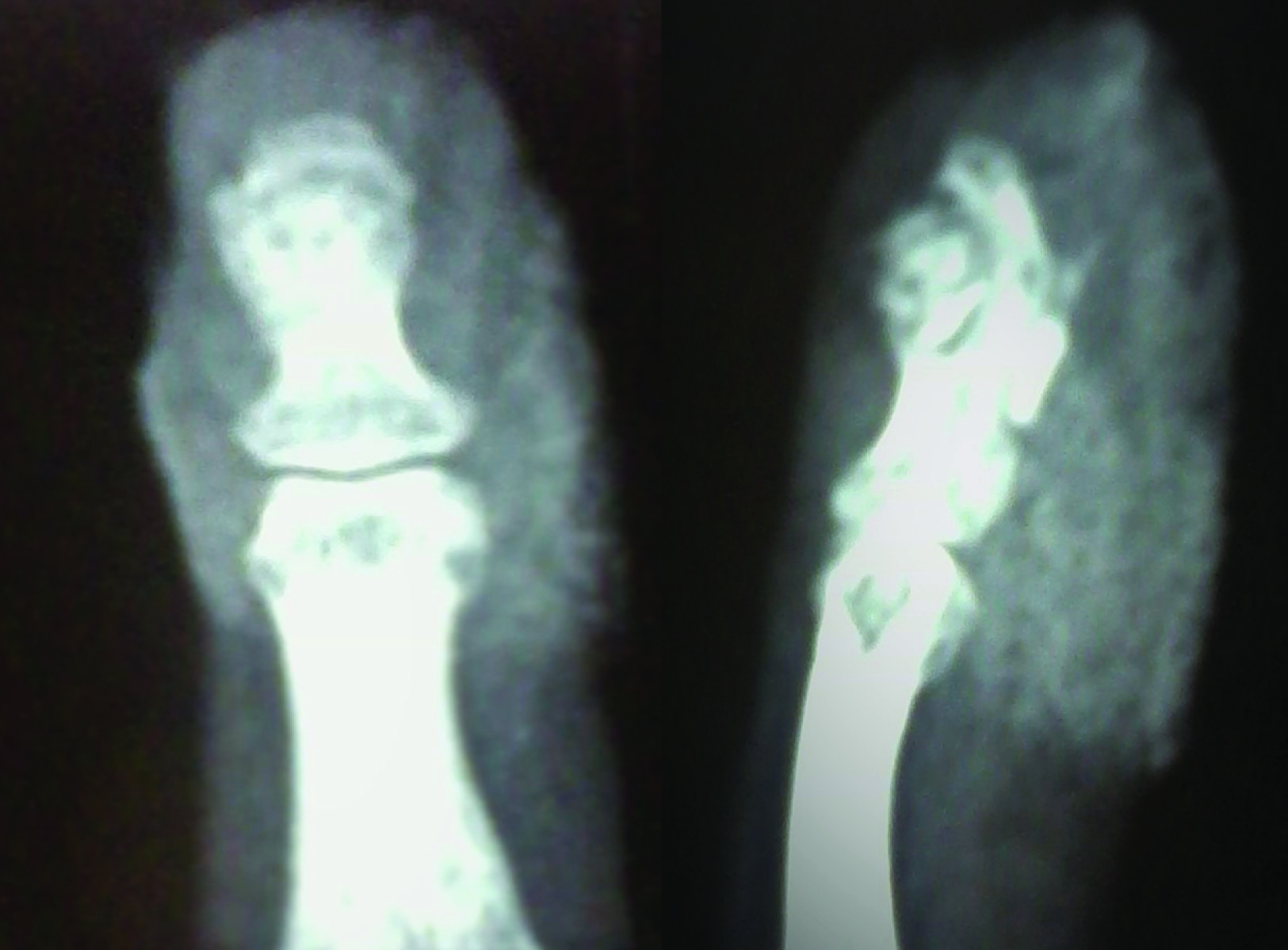 Three months postoperative anteroposterior and lateral radiograph ...