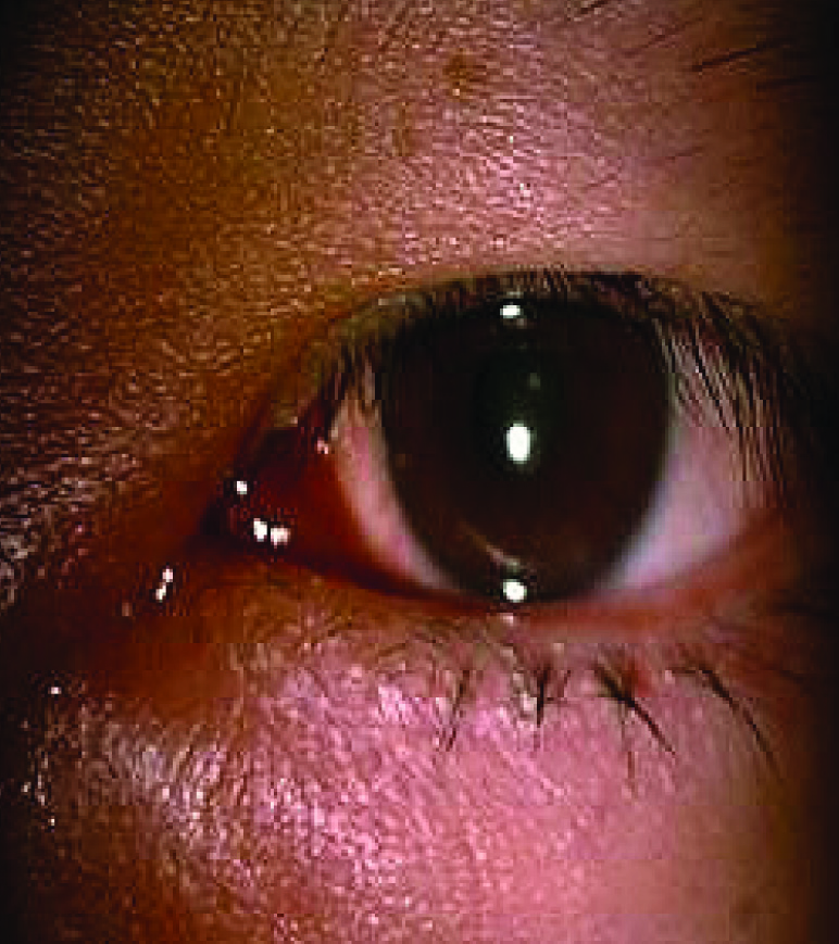 Swelling along medial canthal region