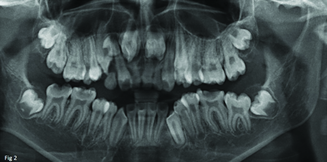 The patient’s father also had similar facial and intraoral features ...
