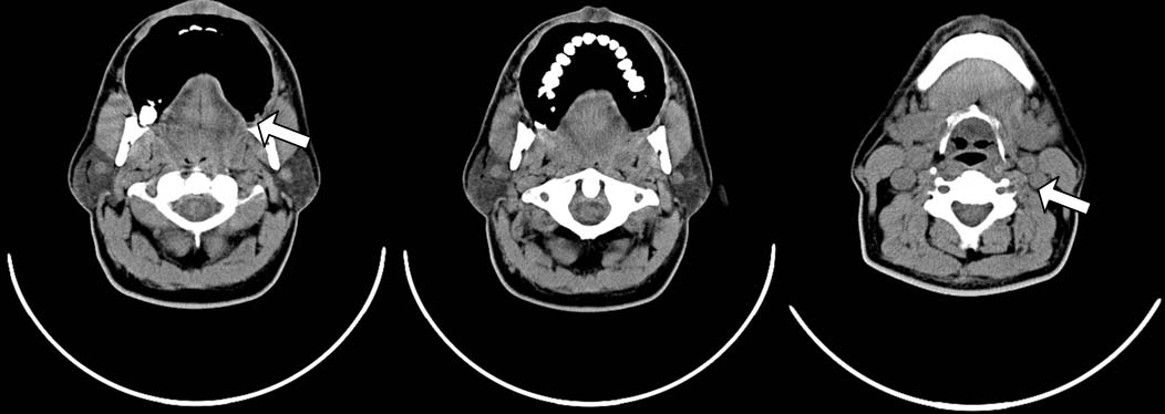 Retromolar Lesion