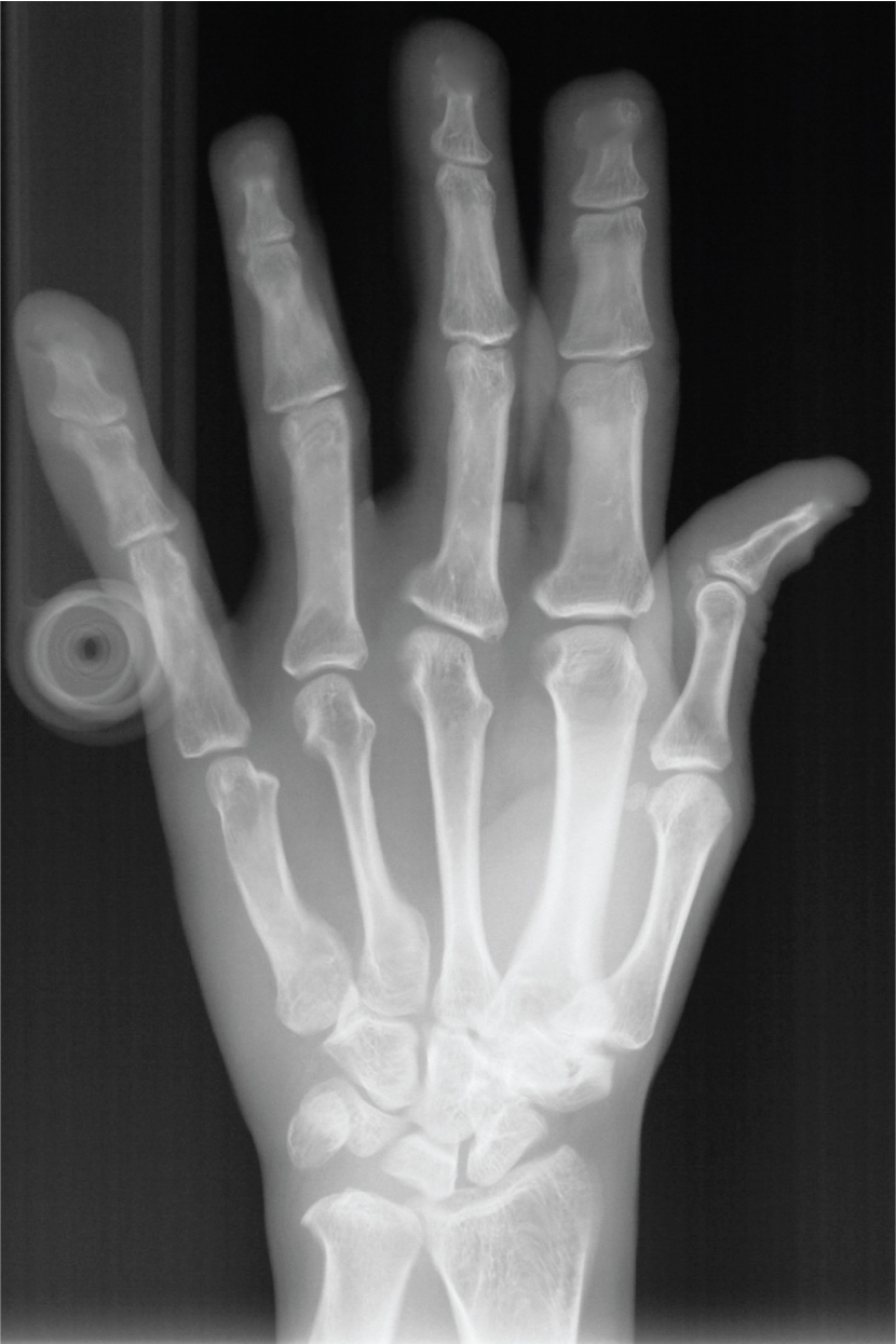 Lateral cephalogram showed an elongated ‘J’ shaped sella, hypoplastic ...