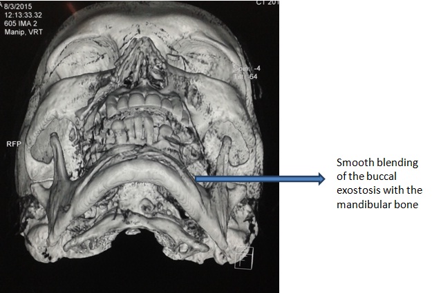 Maxillary Exostosis
