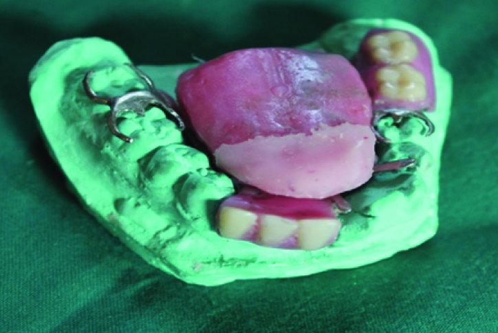 Prosthetic Tongue