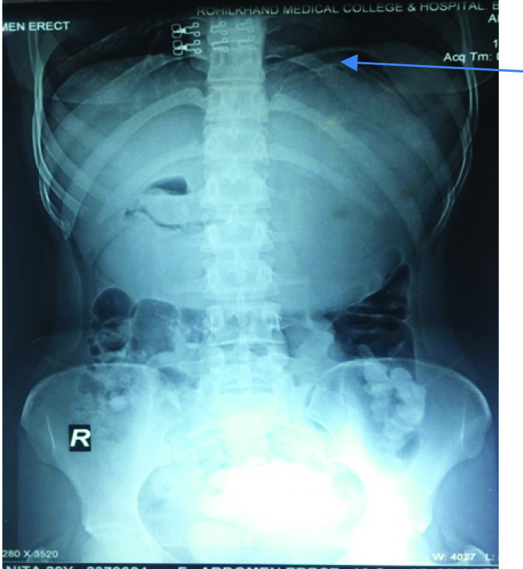 Plain X-ray abdomen AP erect view.