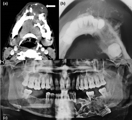 Odontogenic Myxoma Clinical