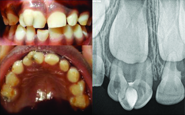 The radiograph revealed three distinct crown and root outlines. The ...