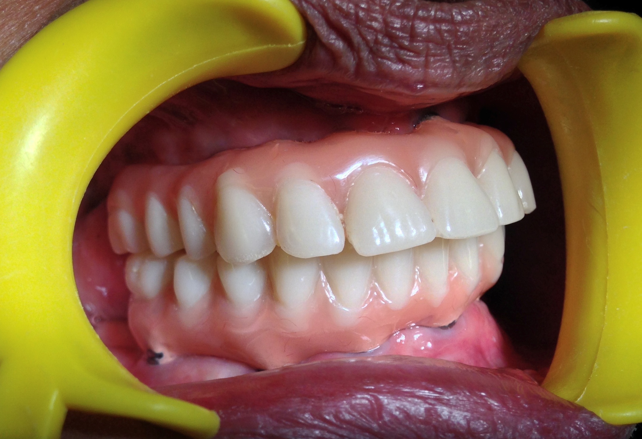 Postoperative OPG