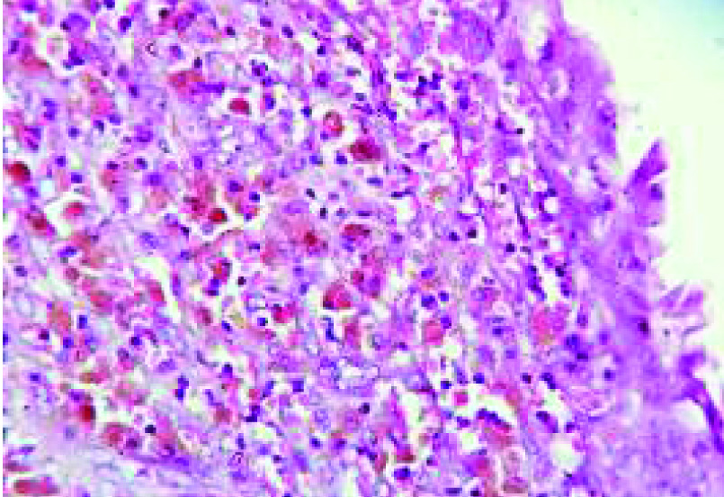 Macrophage With Hemosiderin