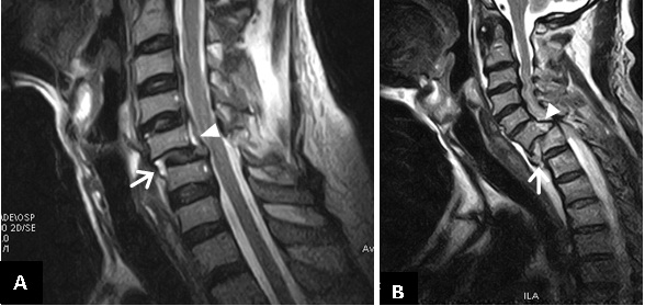 Anterior Longitudinal Ligament Mri Fractures And Dislocations Of The