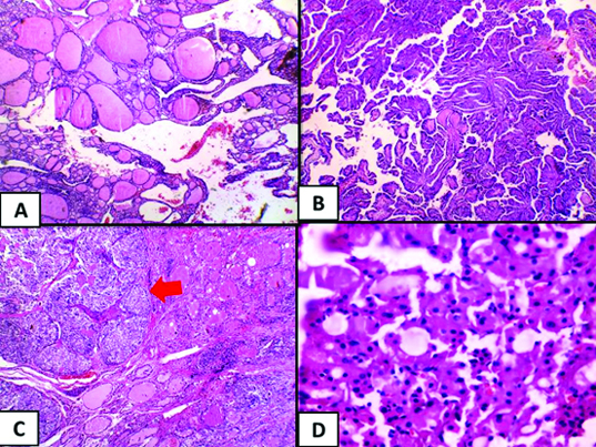 Follicular Thyroid Cancer Hurthle Cell