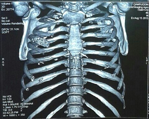 CT-scan of thorax showing heterogenously enhancing soft tissue density ...