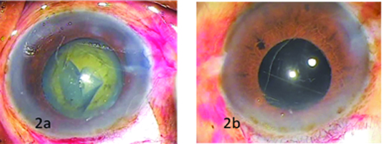 (a) Continuous Curvilinear Capsulorhexis (b) In bag Intraocular Lens.