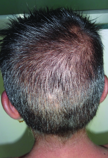 Coarse, straight, lusterless hairs with some areas having more breakage ...