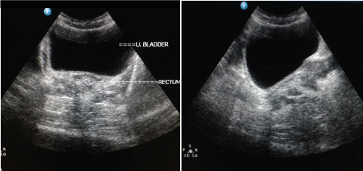 Mullerian Agenesis Ultrasound