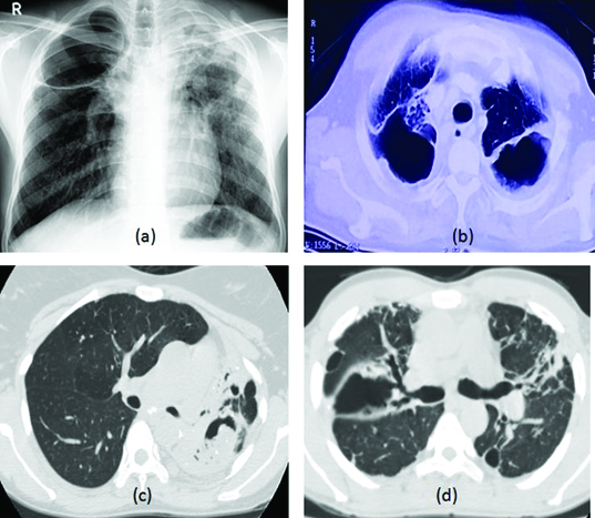 Halo Sign