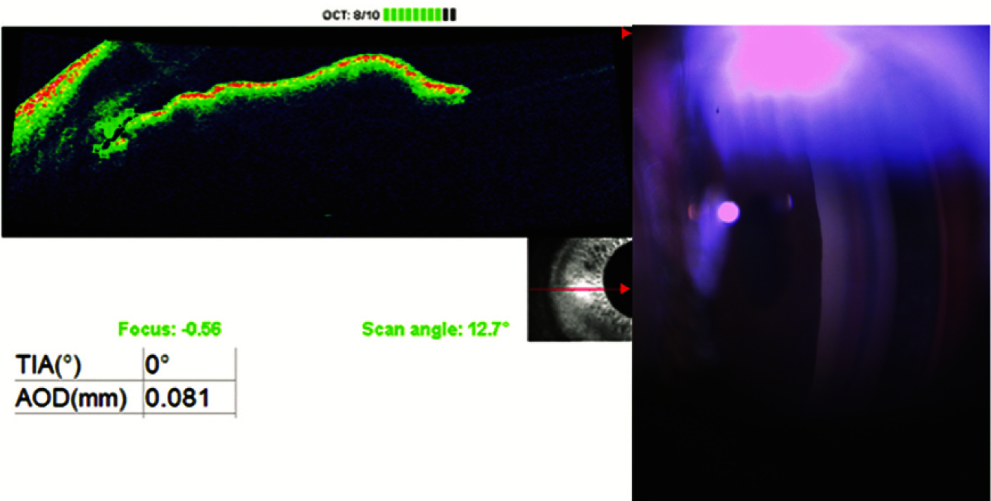 OCT and Gonioscopy Image Showing an Open Angle.