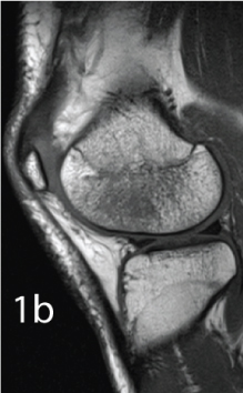 PDFS Saggital: Bone marrow oedema at Lateral femoral and posterolateral ...
