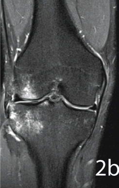 Bone Bruising Around The Knee