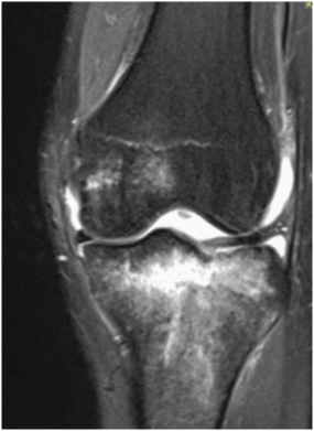 PDFS Coronal: Bone marrow oedema at Medial femoral condyle and proximal ...
