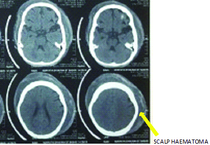 CT – scan showing scalp haematoma.