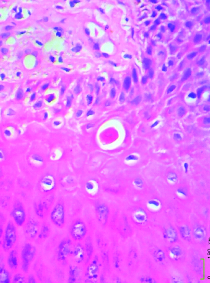 Lichen Planus Histology Civatte Body