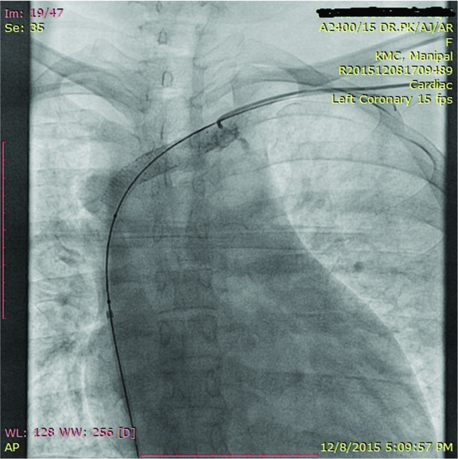 Central venogram showing fully expanded stent at the SVC-Innominate ...