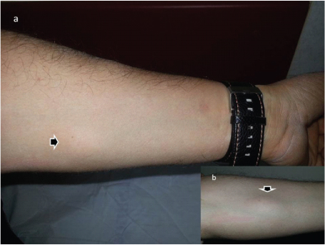 Solid nodular lesion is seen on left forearm.