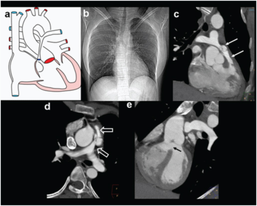 Pulmonary Atresia.