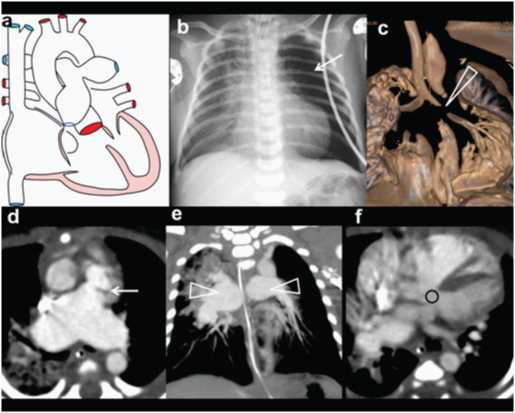 McGoon Ratio = diameters of distal RPA+ distal LPA (immediately pre ...