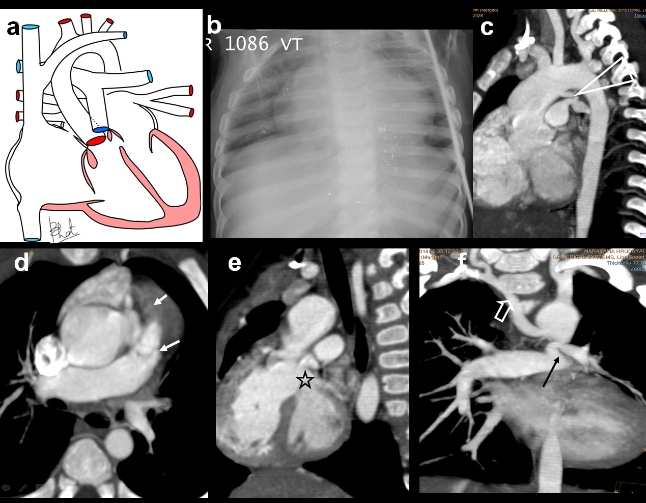 DORV, anomalons conus branch.