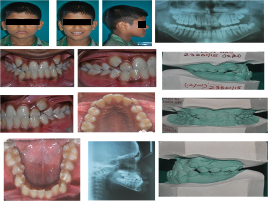 Appliance–Rapid maxillary expander with reverse pull headgear.