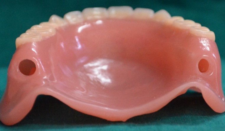 (a) Hollow maxillary complete denture. (b) Hollow denture floating in ...