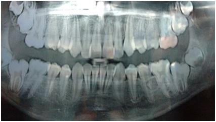 Lateral cephalogram revealed that patient has a horizontal growth ...