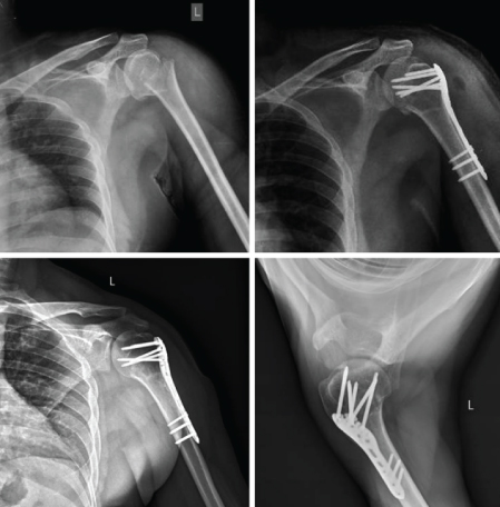 Preoperative, immediate postoperative, follow-up anteroposterior and ...