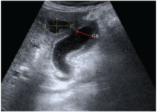 Perforated Gallbladder Ultrasound