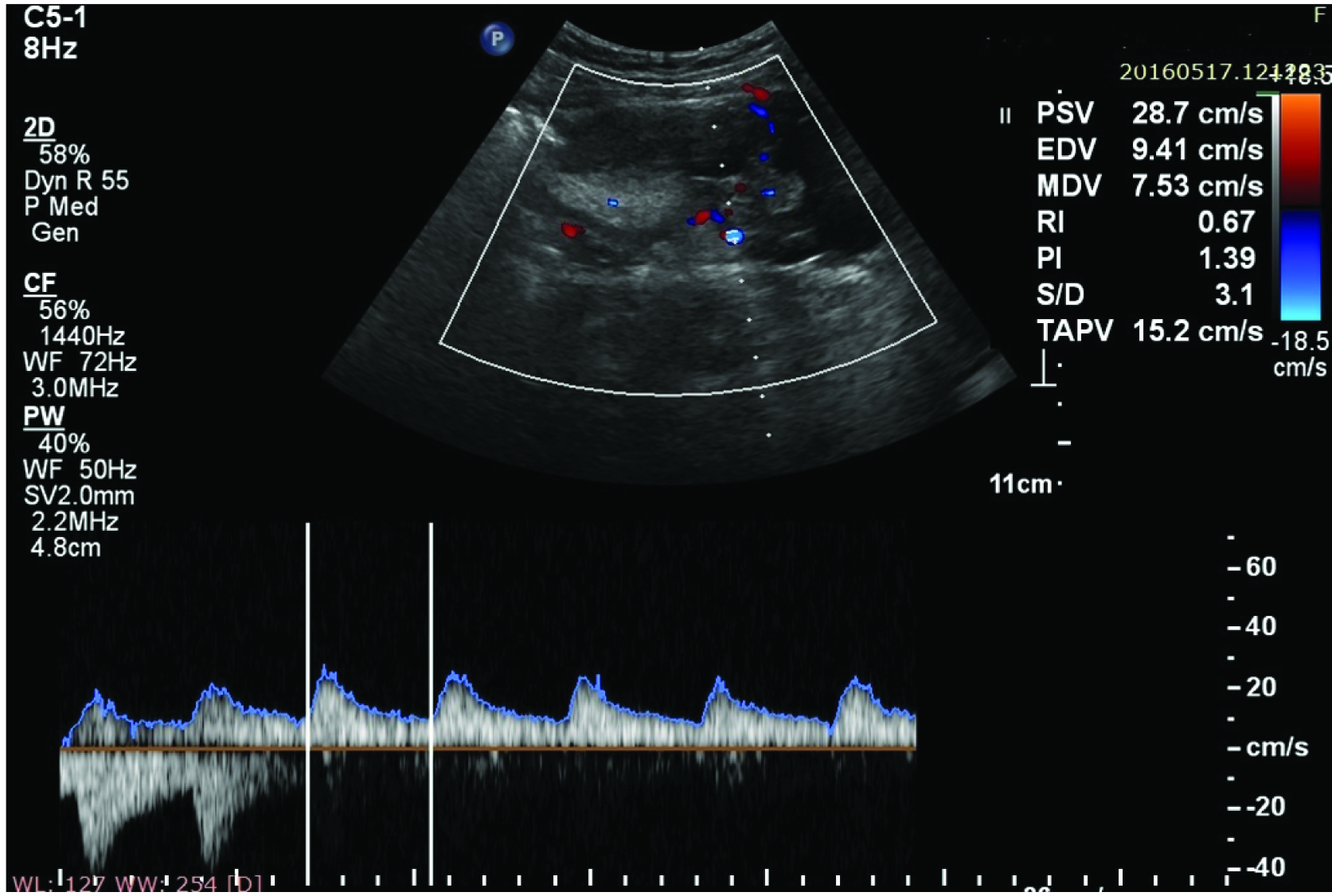 Adnexal mass showing high PI value and high RI value on Spectral ...
