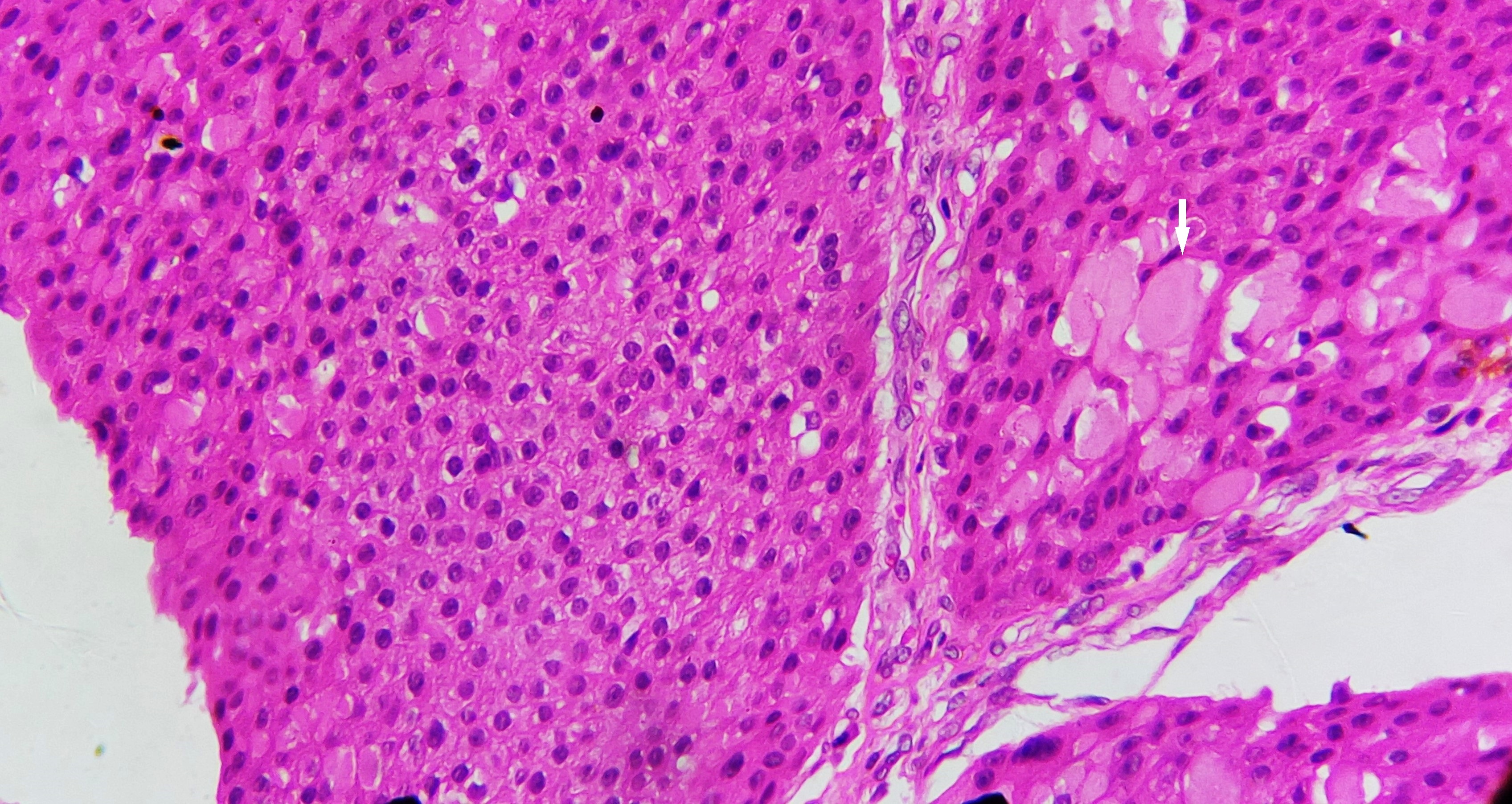 Calcifying Epithelial Odontogenic Tumor Histology