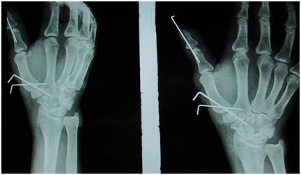 Bennett Fracture Vs Rolando