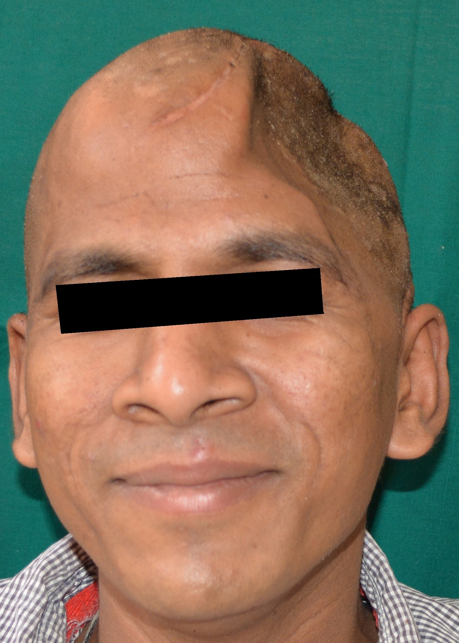 Left lateral view of the cranial defect.