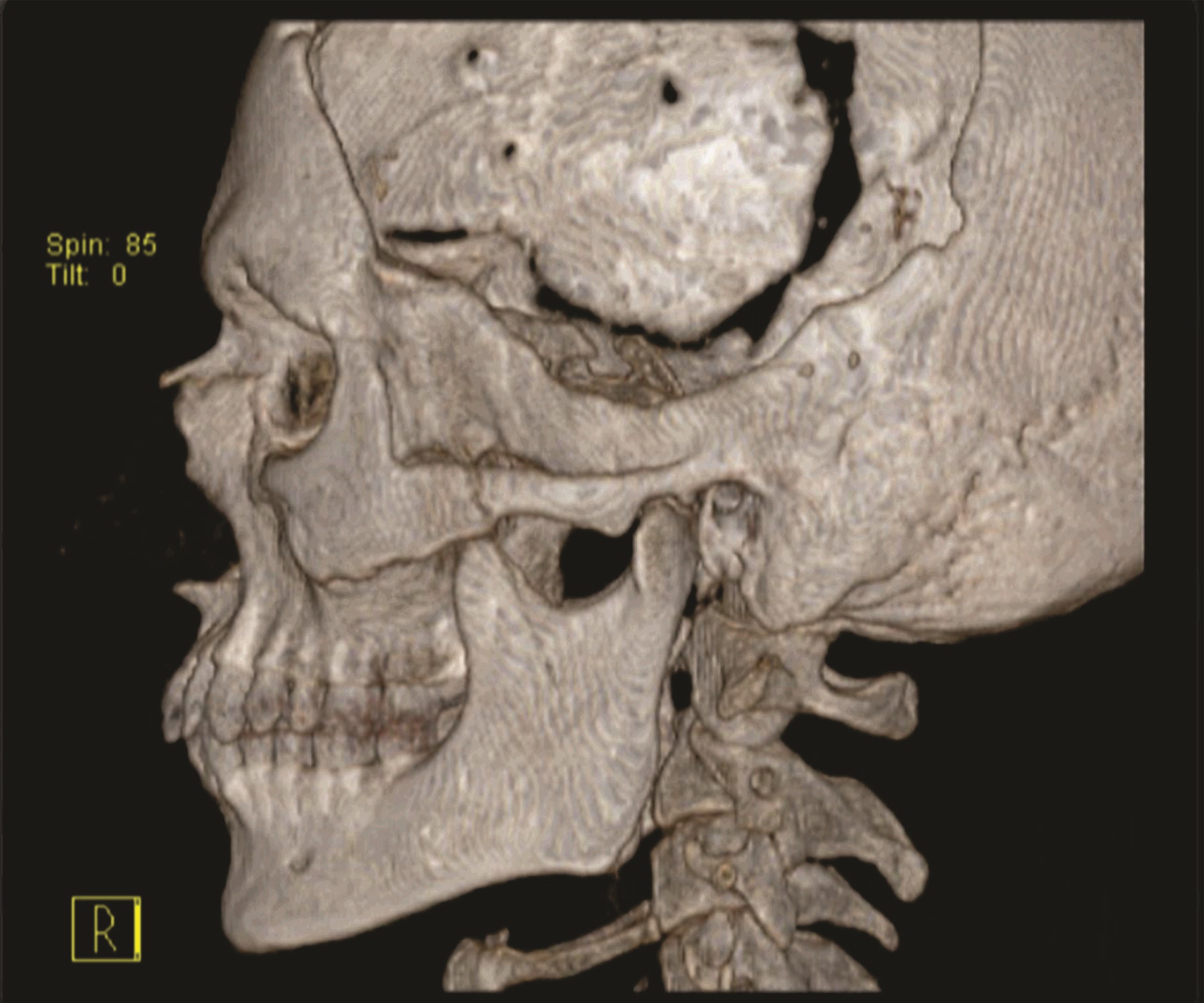 Cranial bone fragment.