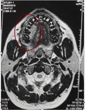MRI showing cortical destruction on right side of palate.