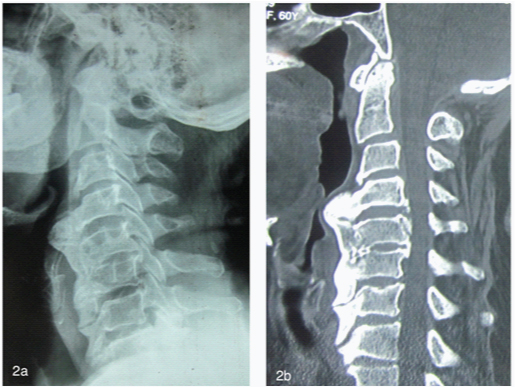 Posterior Longitudinal Ligament Calcification